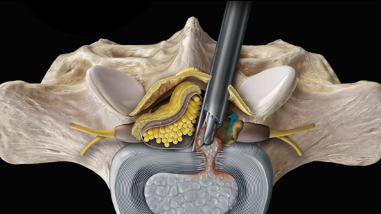Minimally Invasive Spine Surgery : OrthoPedia