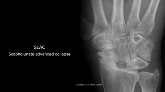 Scaphoid Lunate Advanced Collapse (SLAC) : OrthoPedia