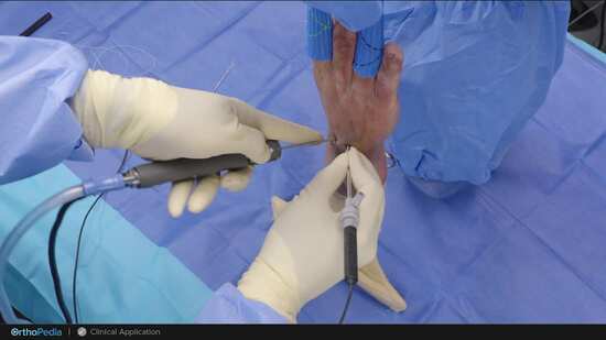 Scapholunate Ligament Injuries: Arthroscopic Volar Scapholunate ...