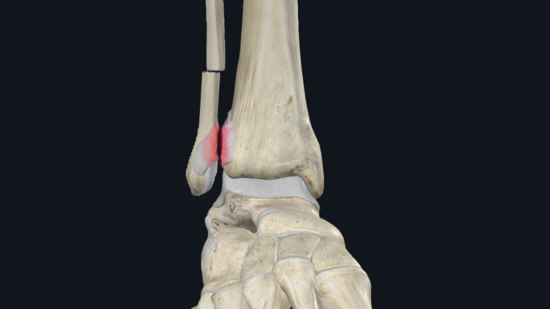Ankle Syndesmosis : OrthoPedia