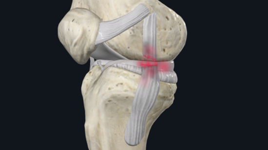 Medial Collateral Ligament (MCL) Injuries : OrthoPedia