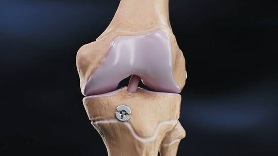 Anterior Cruciate Ligament (ACL) Tears: ACL Reconstruction for ...