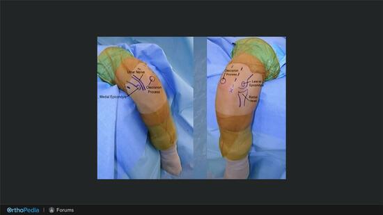 Elbow Arthroscopy Essentials : OrthoPedia Academics