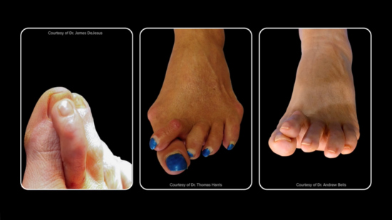 Lesser Toe Pathologies : OrthoPedia Academics