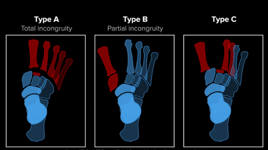 Lisfranc Injuries : OrthoPedia Academics