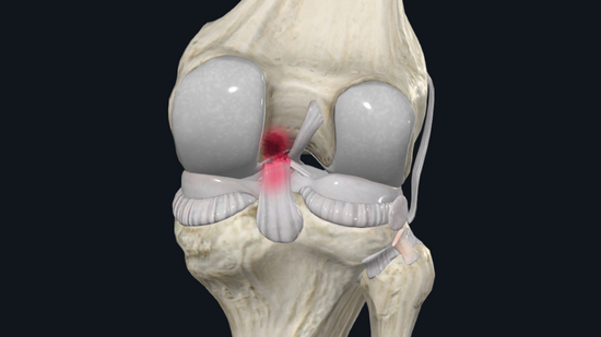 Posterior Cruciate Ligament (PCL) Injuries : OrthoPedia Academics