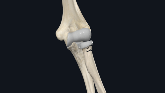 Radial Neck Fractures : OrthoPedia Academics