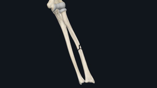 Radial Shaft Fractures : OrthoPedia Academics