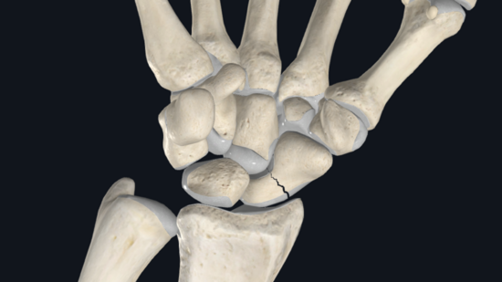 Scaphoid Fractures : OrthoPedia Academics