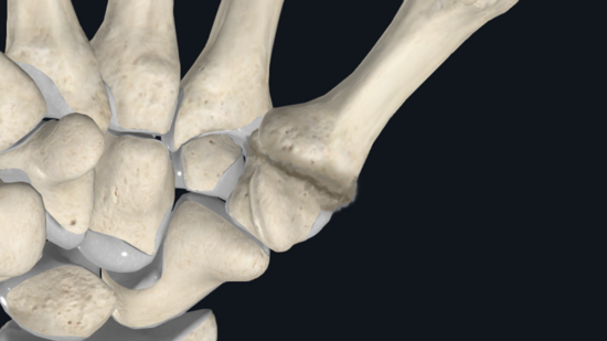 Thumb Carpometacarpal (CMC) Arthritis : Orthopedia Academics