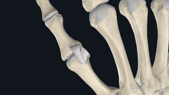 Thumb Ulnar Collateral Ligament (UCL) Injuries : Orthopedia Academics