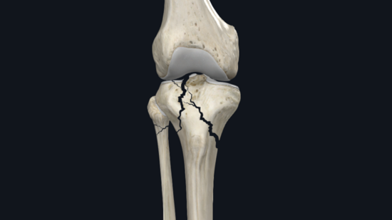 Tibial Plateau Fractures : OrthoPedia Academics