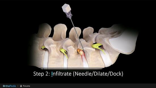 Endoscopic Approaches to Spine: Transforaminal Approach for Discectomy ...