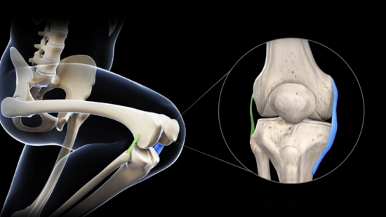 Medial (MCL) and Lateral (LCL) Collateral Ligament Tears : OrthoPedia ...