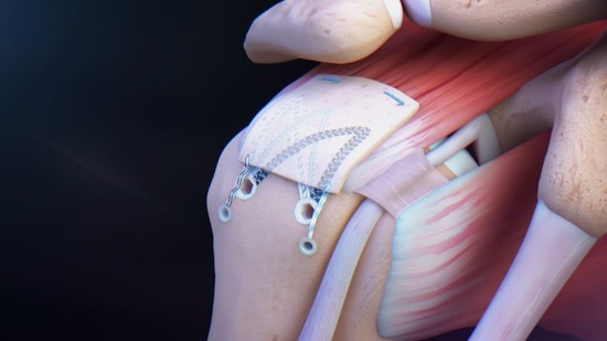 Rotator Cuff Tears: Augmentation of a Rotator Cuff Repair With a ...