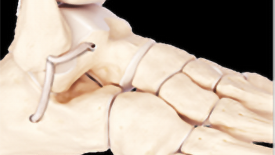 Ankle Instability : OrthoPedia Academics