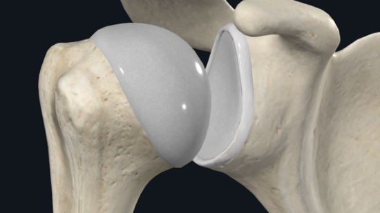 Glenohumeral Joint Instability and Labral Tears : OrthoPedia Academics