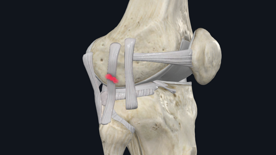 Lateral Collateral Ligament (LCL) Injuries : OrthoPedia Academics