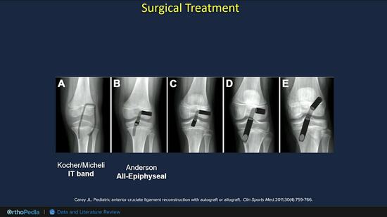 ACL Injuries: Literature Review of ACL Reconstruction Techniques in ...