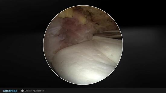Posterosuperior Rotator Cuff Tears: CuffMend™ Augmented Rotator Cuff ...