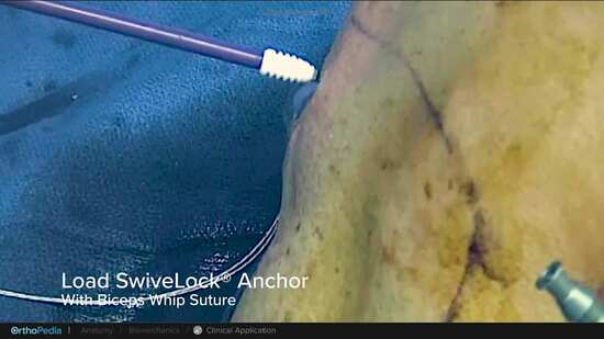 Proximal Biceps Tendinopathy: Arthroscopic High-Groove Tenodesis With ...