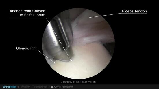 Superior Labrum Anterior Posterior (SLAP) Tears: General Surgical ...