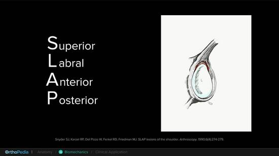 Biomechanics of Superior Labrum Anterior Posterior (SLAP) Tears ...