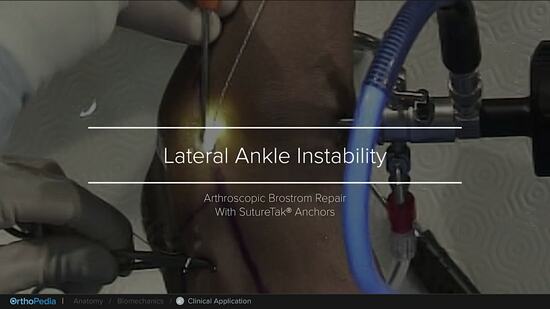 Lateral Ankle Ligament Injuries: Arthroscopic Brostrom Repair With ...