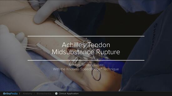 Achilles Tendon Midsubstance Rupture: Achilles Tendon Repair With the ...