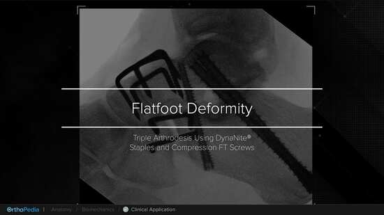 Flatfoot Deformity: Flatfoot Reconstruction With a Triple Arthrodesis ...