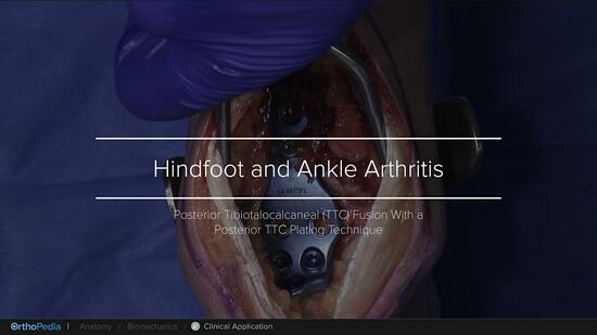 Hindfoot Arthritis: Posterior Tibiotalocalcaneal Fusion With the ...