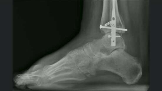 Innovations in Trauma Surgery, Part 3: Ankle Innovations in Trauma ...