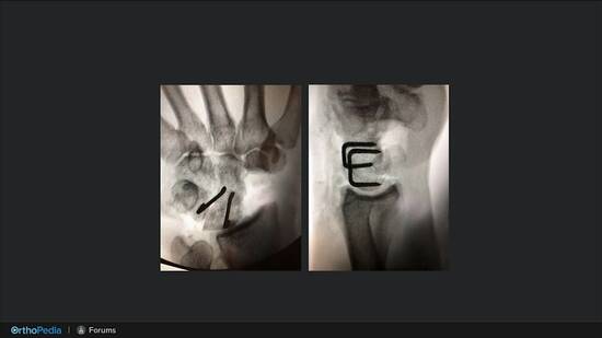 DynaNite® Nitinol Compression Staples for 4-Corner Fusion in SLAC Wrist ...