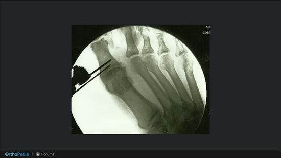 Innovations in the Treatment of Hallux Rigidus: Part 3—Understanding ...
