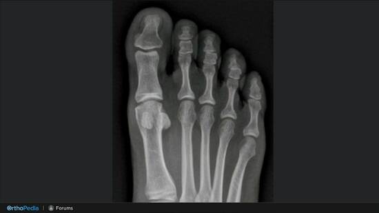 Foot and Ankle Procedures I'm Performing Using the NanoScope ...