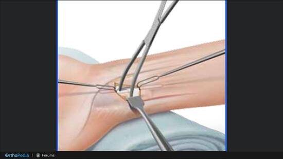 NanoScope™ Operative Arthroscopy System and Minimally Invasive Hand ...