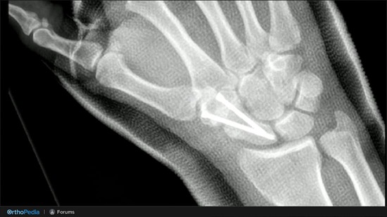 NanoScope™ Visualization System, Trauma, and Minimally Invasive Hand ...