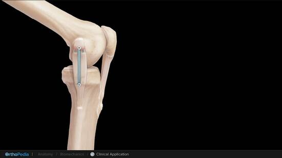 Collateral Ligament Injuries: MCL Repair Using the InternalBrace ...