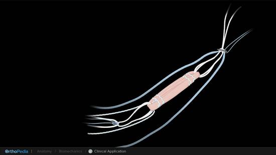 ACL Injuries: Hamstring Tendon Graft Preparation for the GraftLink ...