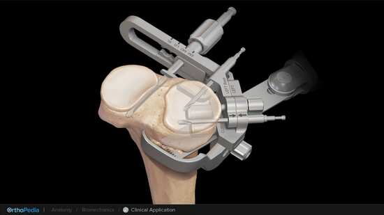 Knee Arthritis: Proximal Tibia Opening Wedge Osteotomy Using iBalance ...