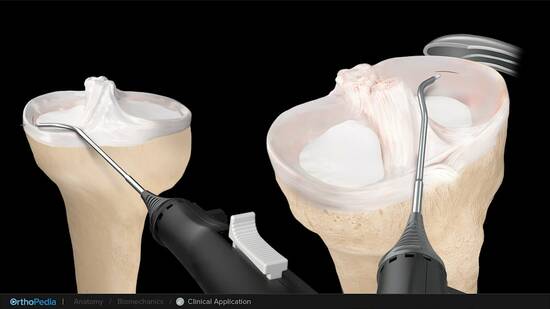 Meniscal Pathology: Inside-Out Meniscus Repair Using the ZoneNavigator ...
