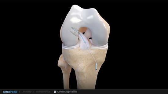 ACL Injuries: Arthroscopic All-Inside ACL Primary Repair Using the ...