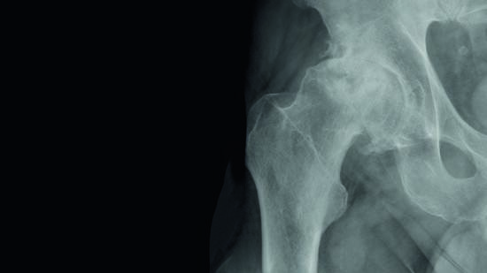 Anatomy of the Hip With Arthritis : OrthoPedia Academics