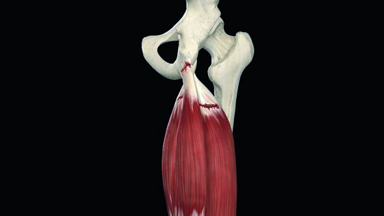 Anatomy of the Hip With Proximal Hamstring Tears : OrthoPedia Academics