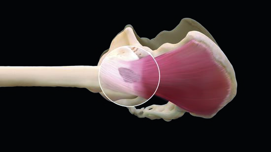 Peritrochanteric Hip Pathologies: Endoscopic Knotless Repair Using ...