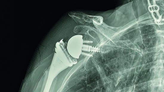 Approach to Revision Total Shoulder Arthroplasty : OrthoPedia Academics