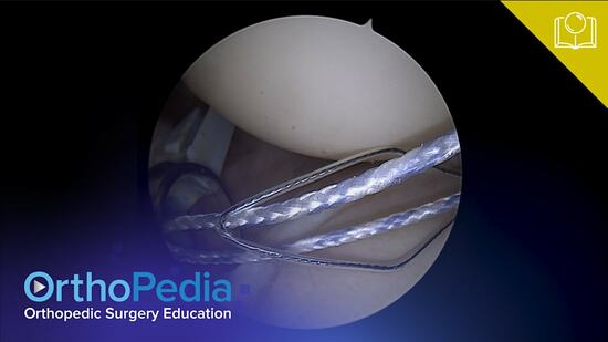 Dr. Denard Demonstrates Tips and Pearls for Shoulder Glenohumeral ...