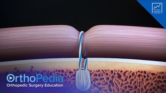 ACL Injuries: Literature Review on Iliotibial Band Tenodesis for ...