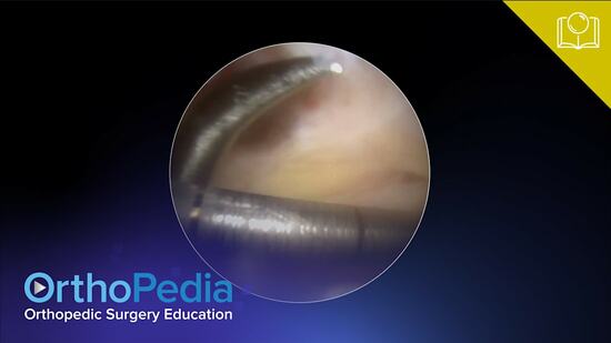 Dr. Maak Demonstrates Tips and Pearls for ACL Injuries: Microfracture ...