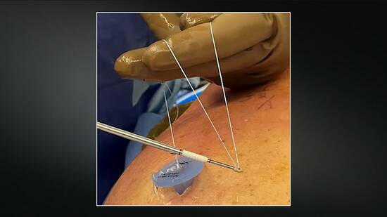 Dr. Suri Demonstrates Tips and Pearls for Rotator Cuff Repair: The ...